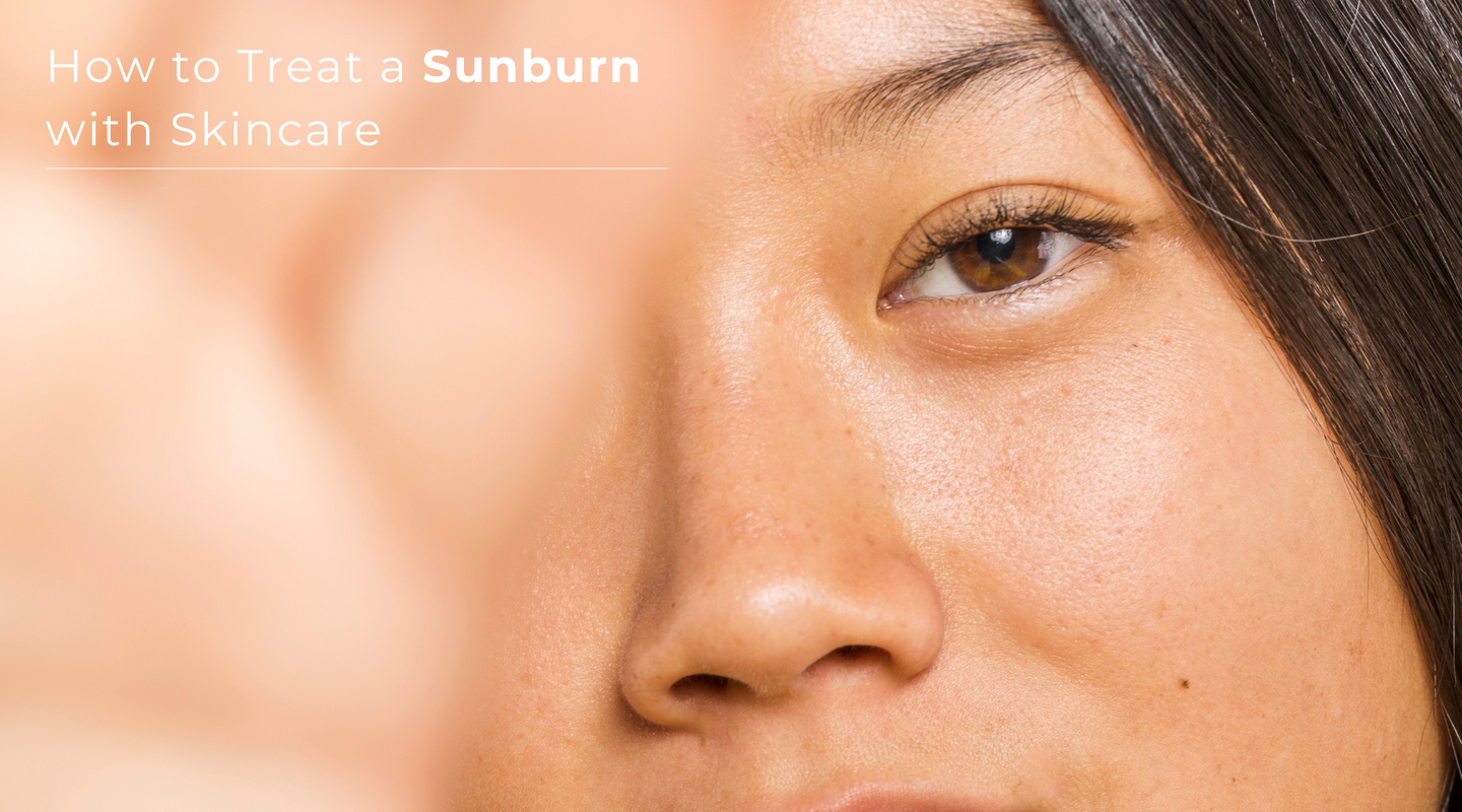 How to Treat a Sunburn with Skincare: A Comprehensive Guide – Long Story